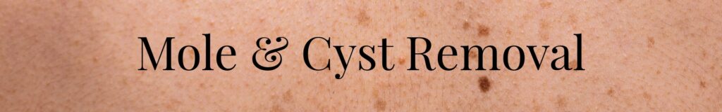 Mole & Cyst Removal - Scott Plastic Surgery