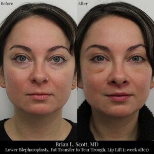 Lip Lift - Scott Plastic Surgery